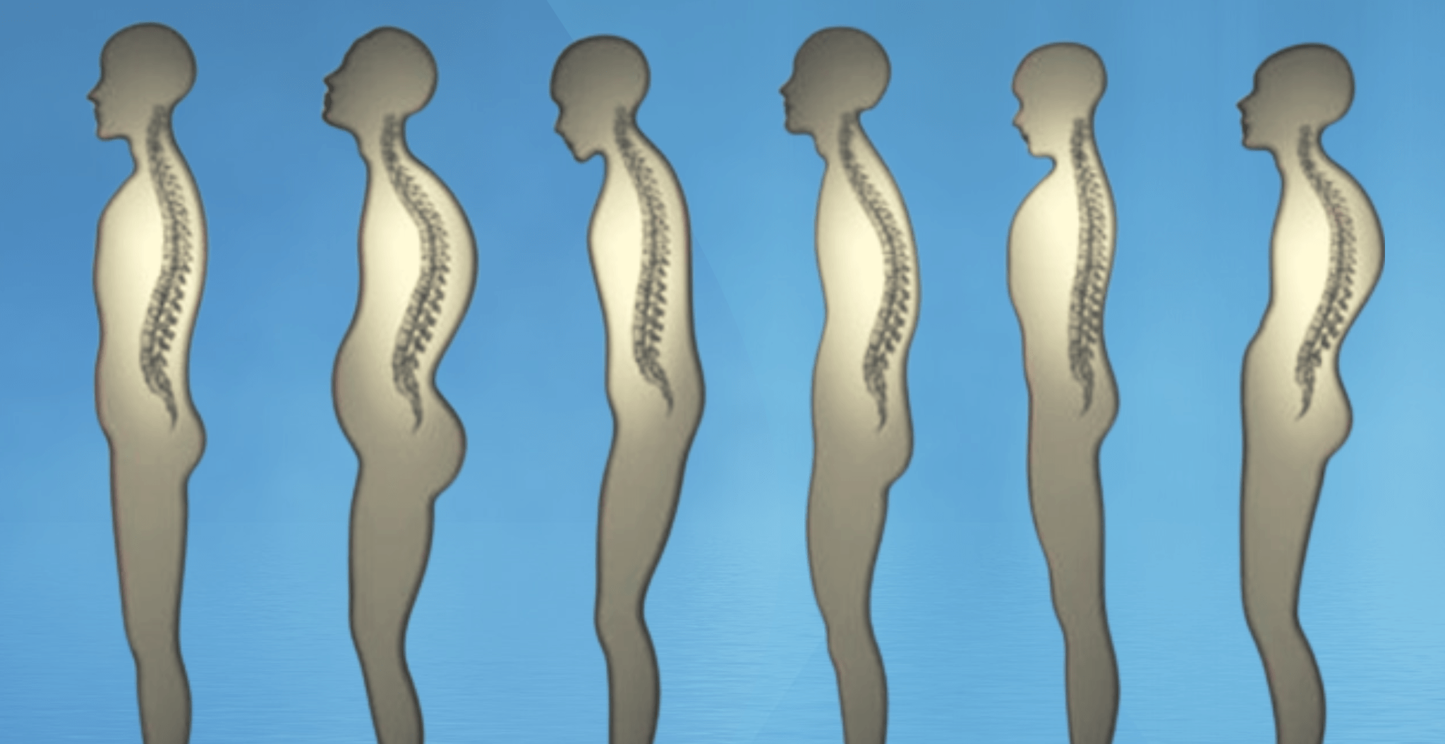 Postural Dysfunction - Marcel Jacobs PT - Midtown Manhattan Physical ...